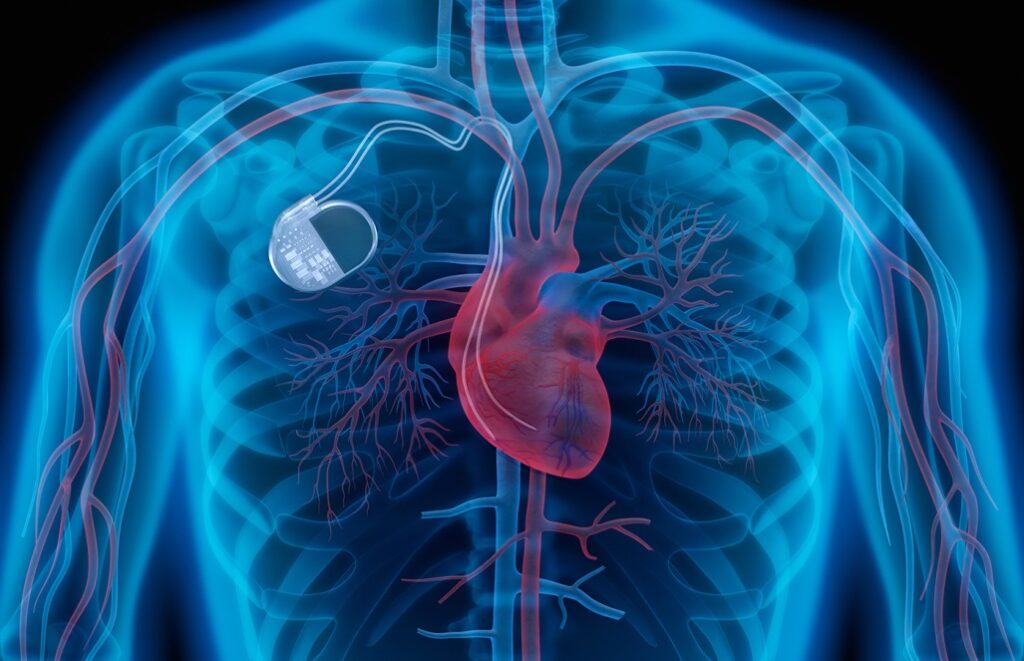 "Pacemaker Patent: The Accidental Invention That Saved Lives"